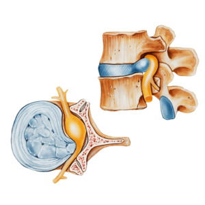 Anterior Cervical Corpectomy and Fusion | Dallas-Fort Worth, TX ...