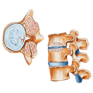 Cervical Disc Replacement in Southlake | Surgical Procedure